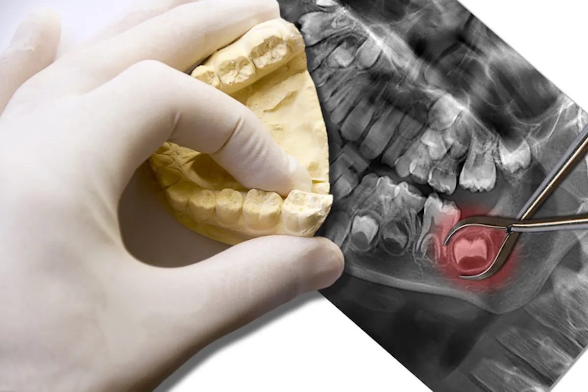 Broken, Chipped, or Cracked Wisdom Tooth | Bergen Oral Surgery