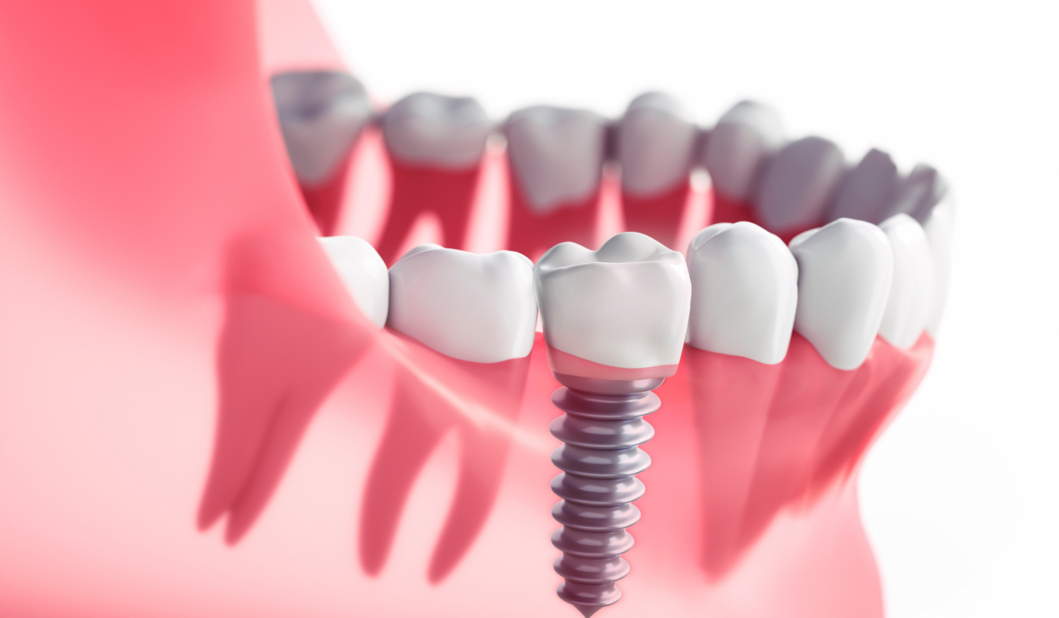 What Happens During All-on-4 Surgery? | Bergen Oral Surgery